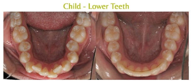 Permanent Retainer Libertyville IL Arpino Orthodontics Lake Bluff